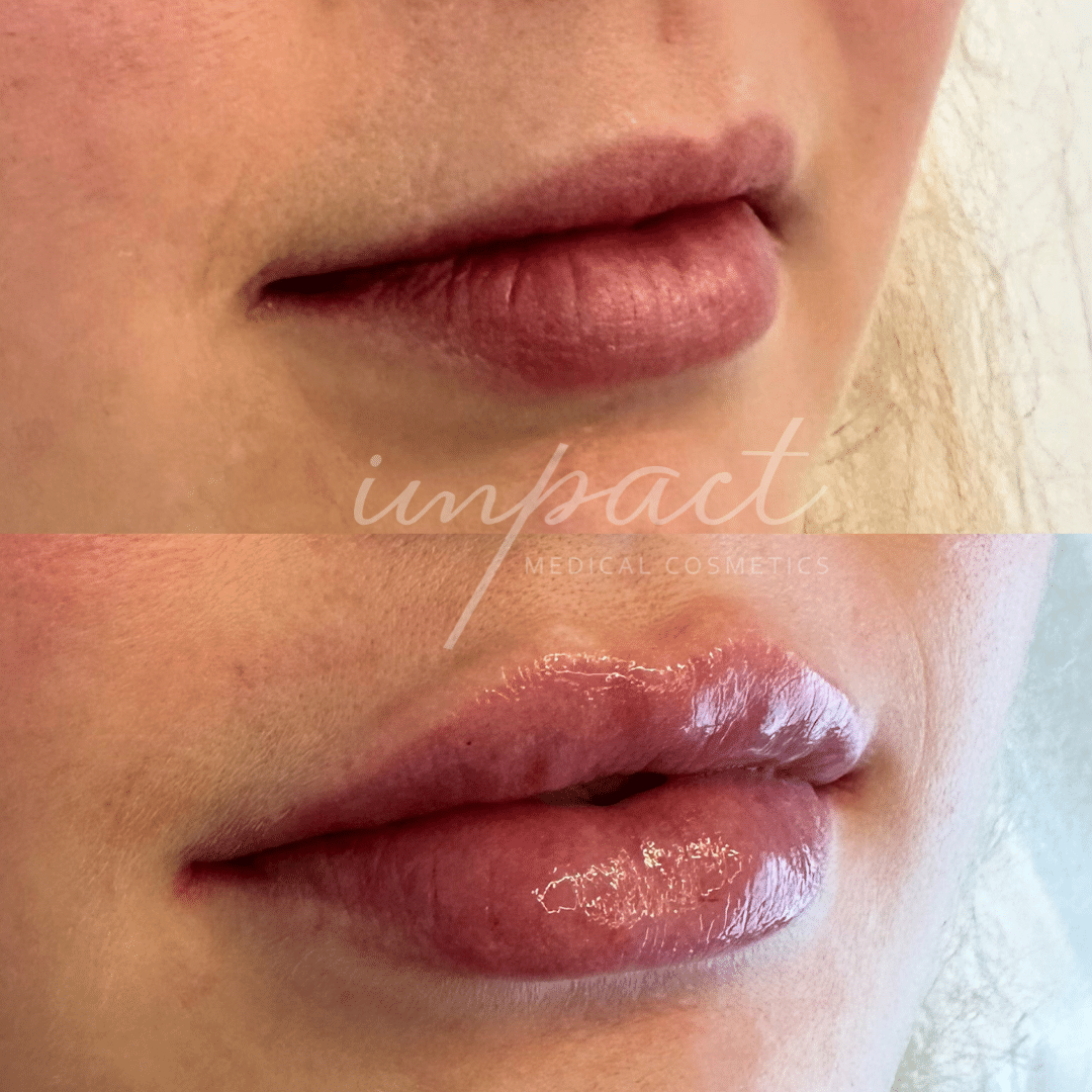 Lip Fillers Oakville | Get the Perfect Pout